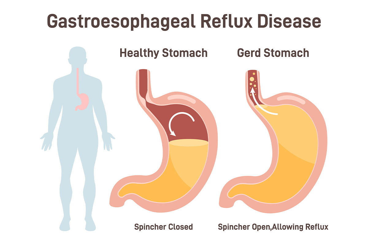 Acid Reflux Surgery | BetterLife Surgery