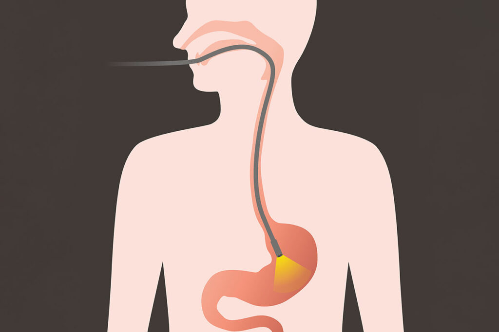 Gastroscopy | BetterLife Surgery