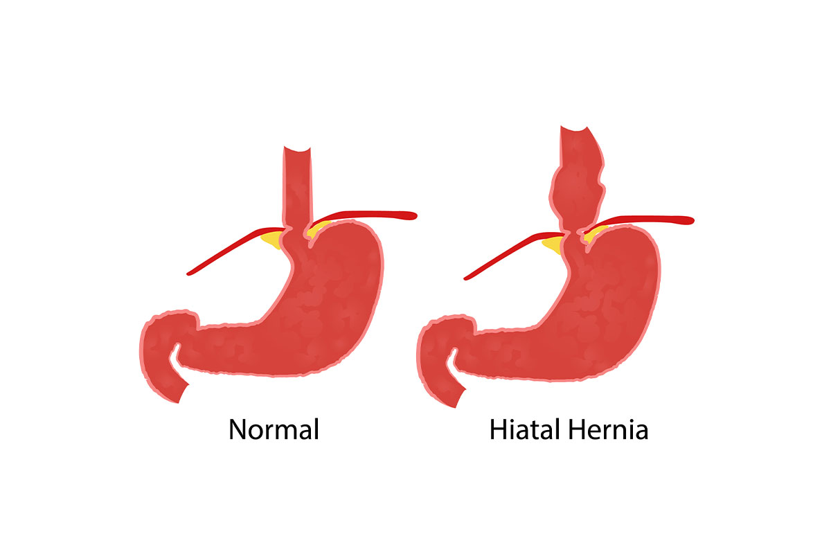 Acid Reflux Surgery | BetterLife Surgery