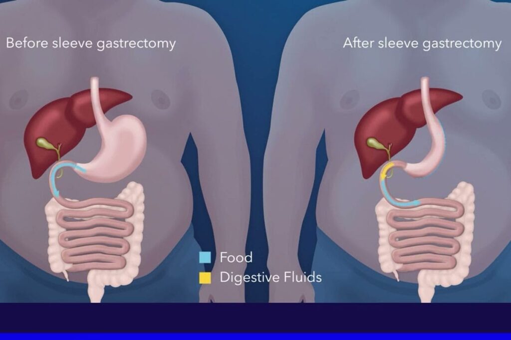 Gastric Sleeve in Melbourne | BetterLife Surgery