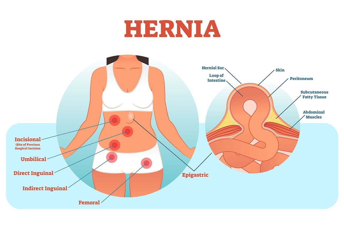 Hernia Surgery Betterlife Surgery